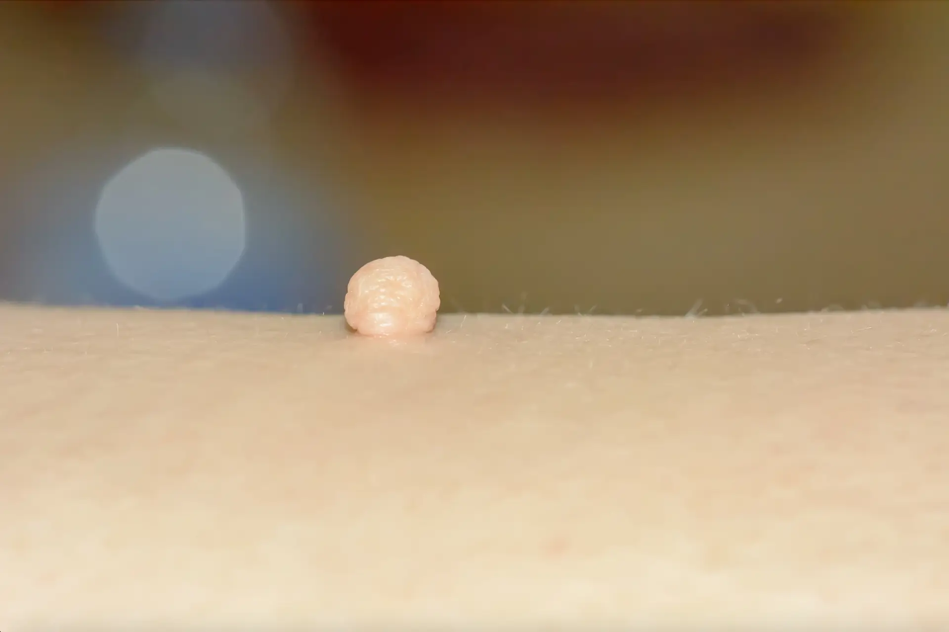 Skin Tag treatment in Sevenoaks - Ü Skin - Skin Clinic